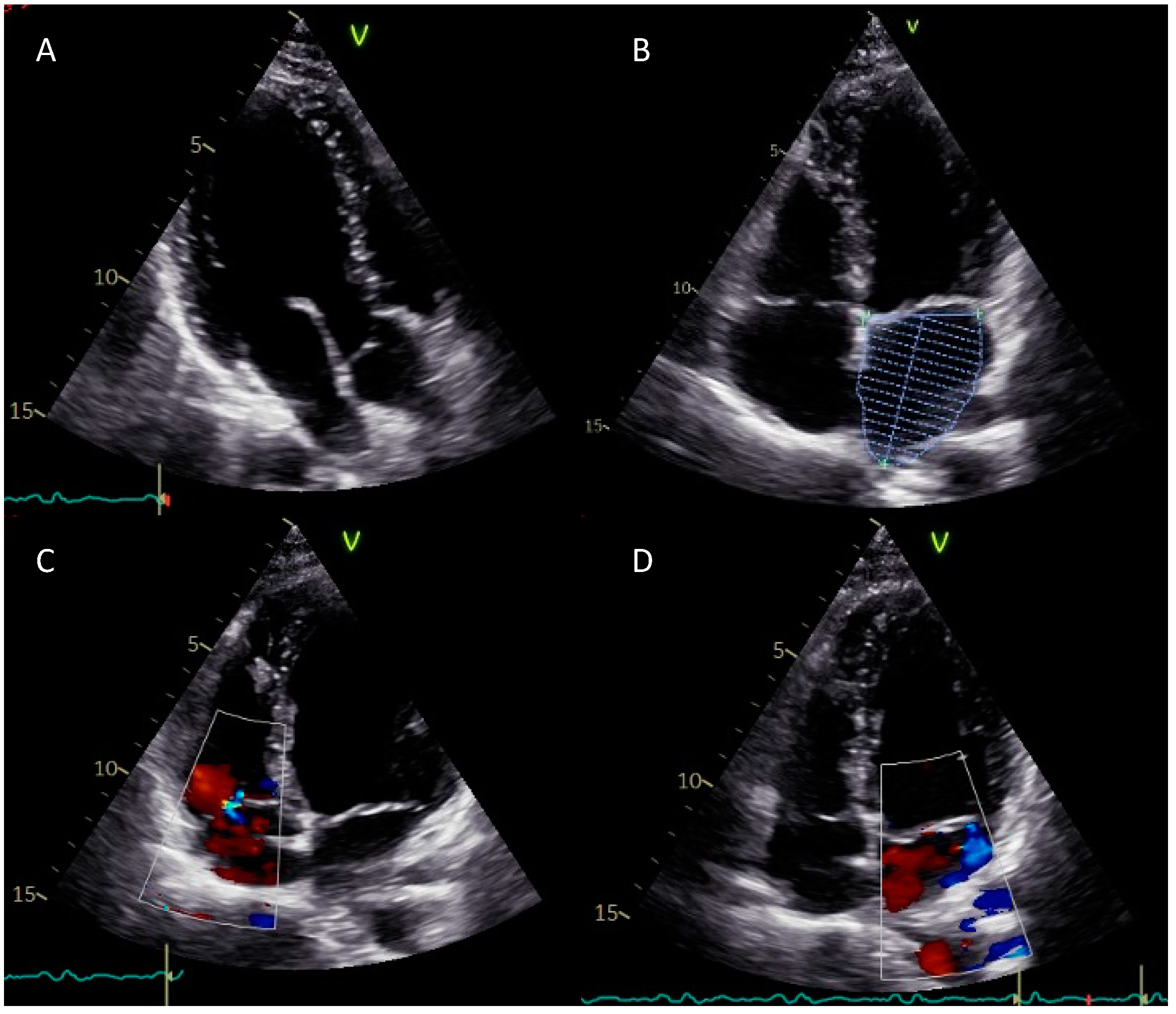 Paroxysmal Atrial Fibrillation with Rapid Ventricular Response Following COVID-19 Nasopharyngeal ...