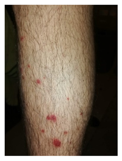 Paroxysmal Nocturnal Hemoglobinuria: A Case Report in a Pandemic ...