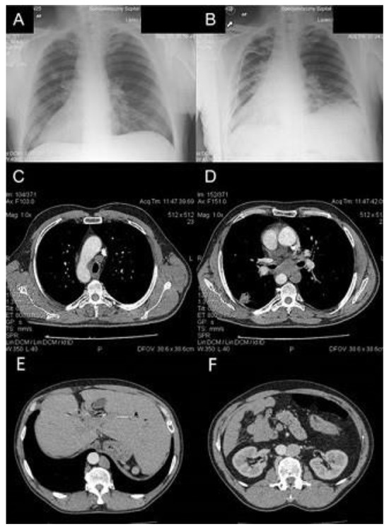 Reports | Free Full-Text | Surgical Treatment of Lung Cancer in Situs ...
