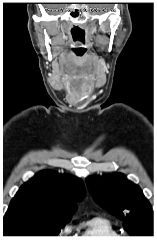 Hyoid Bone Metastases: An Unusual Case