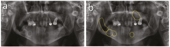 Surgical Treatment of Multiple Bone Cysts Using a Platelet-Rich Fibrin ...