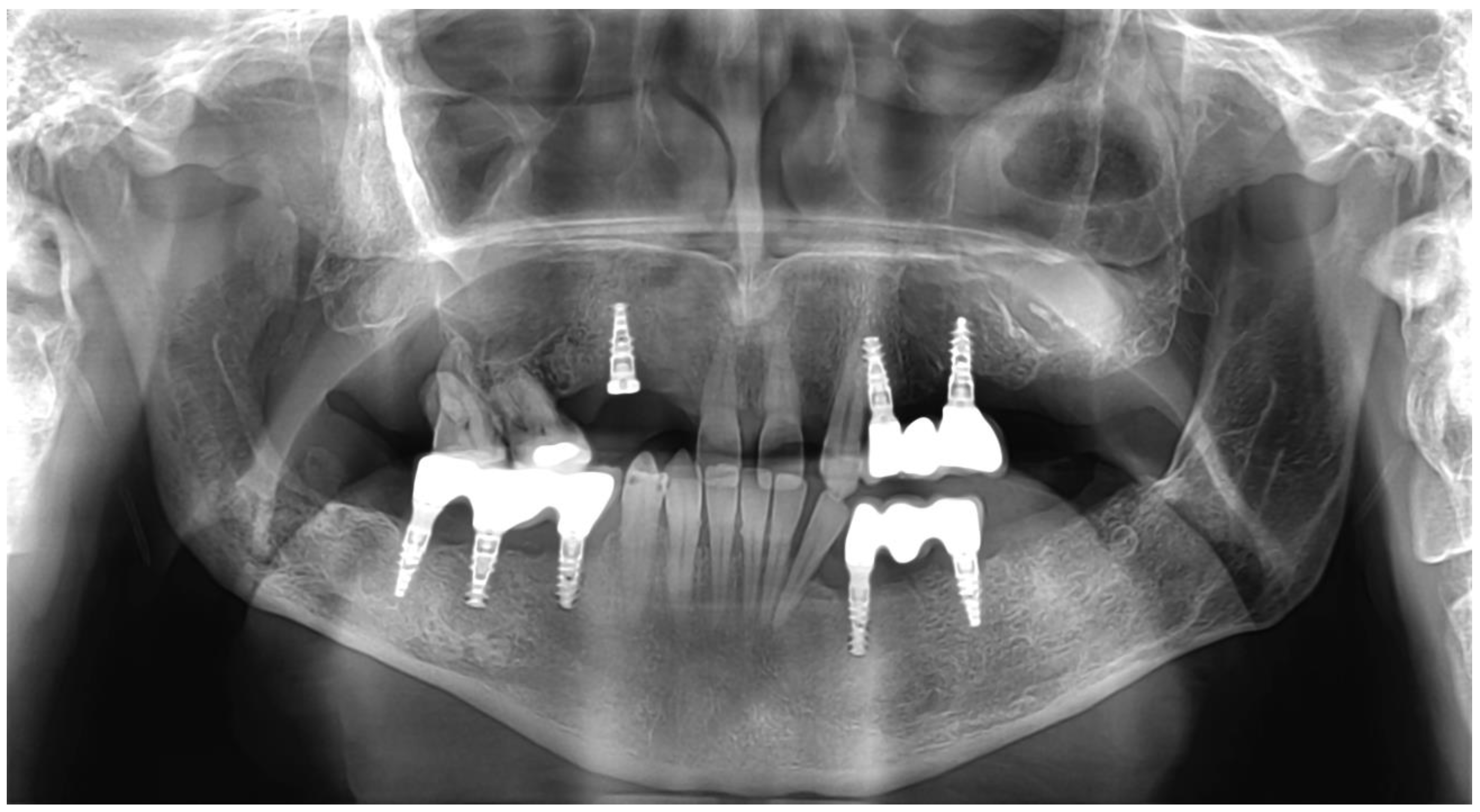 Surgical Treatment of Multiple Bone Cysts Using a Platelet-Rich Fibrin ...