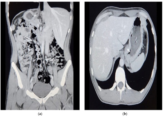 A Newly Reported Late Complication of Endoscopic Fundoplication: A Case ...