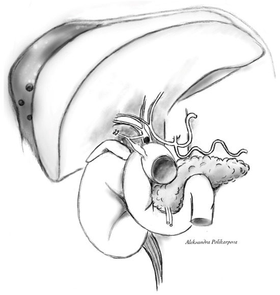 Cystic Duct Remnant–Duodenal Fistula following Laparoscopic ...