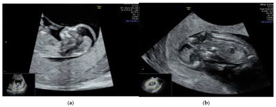 Amnion Rupture Sequence
