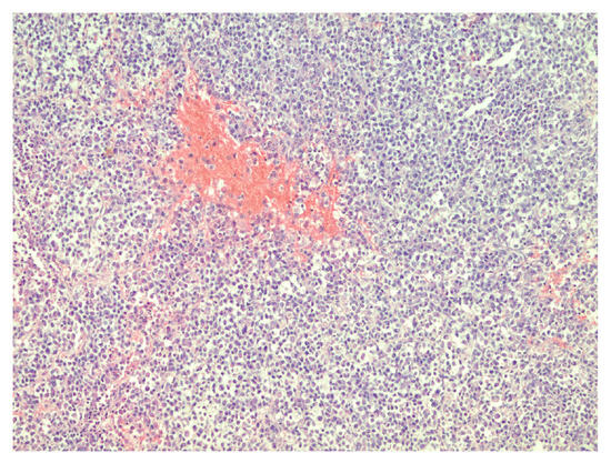 Atypical Teratoid/Rhabdoid Tumor with Retained SMARCB1 (INI1 ...