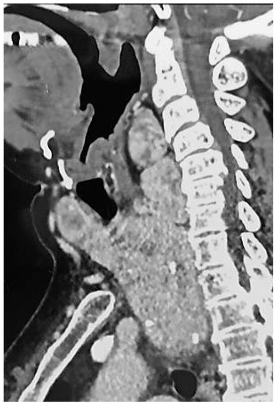 The Resolution of Obstructive Sleep Apnea in a Patient with Goiter ...