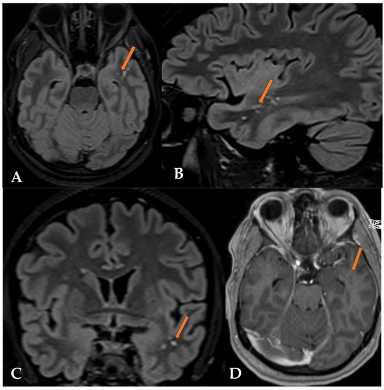 Multinodular Vacuolating Neuronal Tumors: Symptomatic Presentation ...
