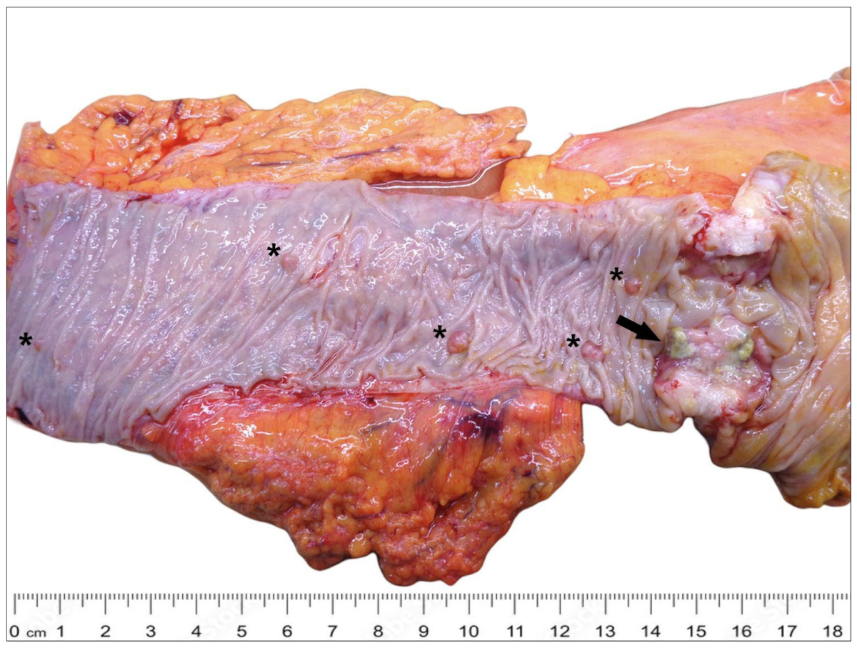 Extra-Appendiceal Neuroendocrine Expressing Goblet Cell Adenocarcinoma ...