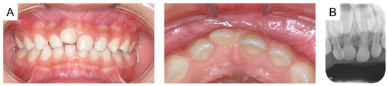 Long-Term Follow-Up of a Patient with Ankylosis of a Primary Incisor ...