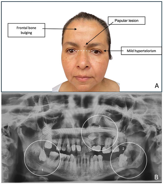 Clinical Features and PTCH1 Expression in Gorlin–Goltz Syndrome: A Case ...