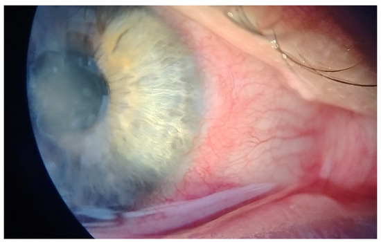 Successful Treatment of Acanthamoeba Keratitis According to New ...