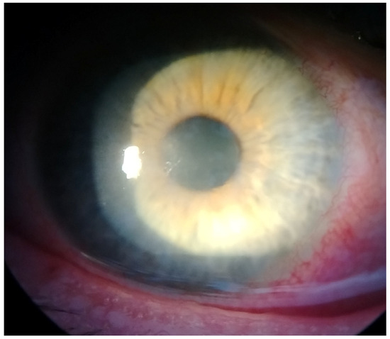 Successful Treatment of Acanthamoeba Keratitis According to New ...