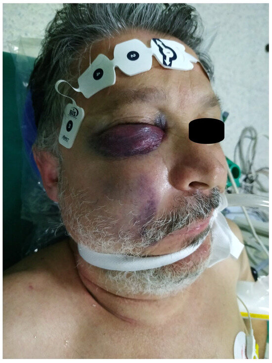 Rapidly Progressive Buccal Hematoma Following Local Anesthetic ...