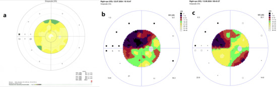 Is Semaglutide Linked to NAION? A Case Report on a Rare Ocular Complication