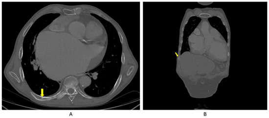 Paget’s Disease of Bone and Normocalcemic Variant of Primary ...