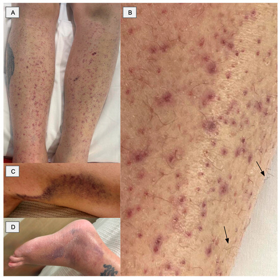Pseudovasculitic Scurvy Mimicking Small Vessel Vasculitis: A Case Report