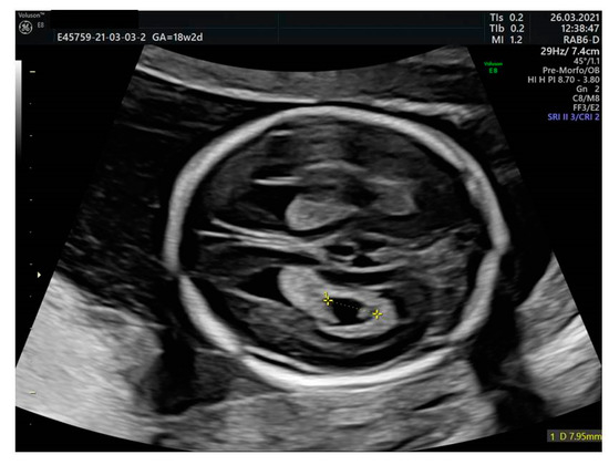 Choroid Plexus Cyst Ultrasound
