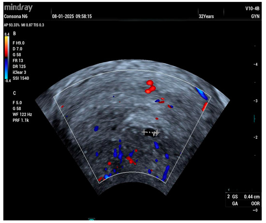 Outpatient Hysteroscopic Treatment of Cervical Ectopic Pregnancy in a ...