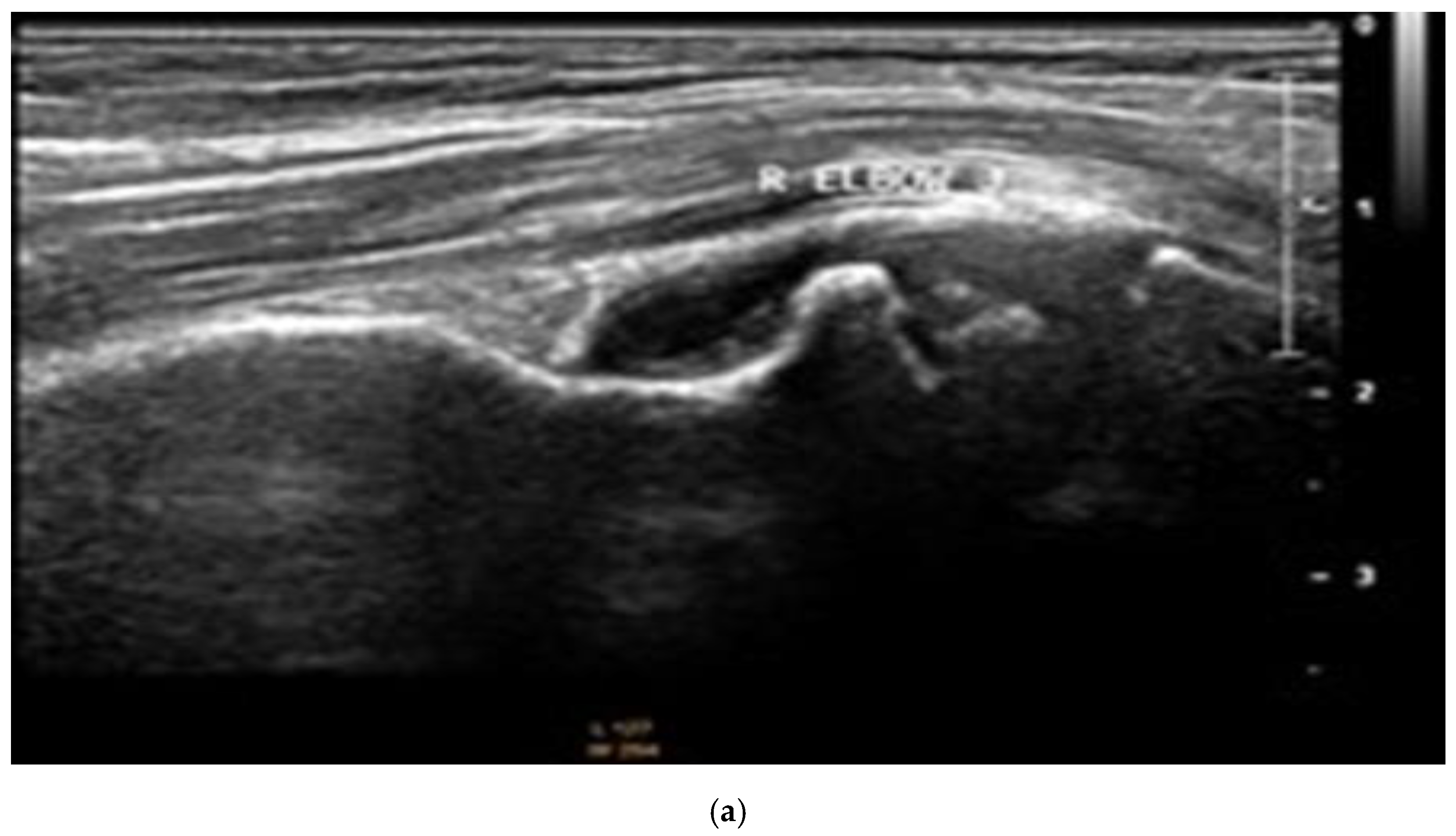 Ultrasound Features across Subtypes of Juvenile Idiopathic Arthritis