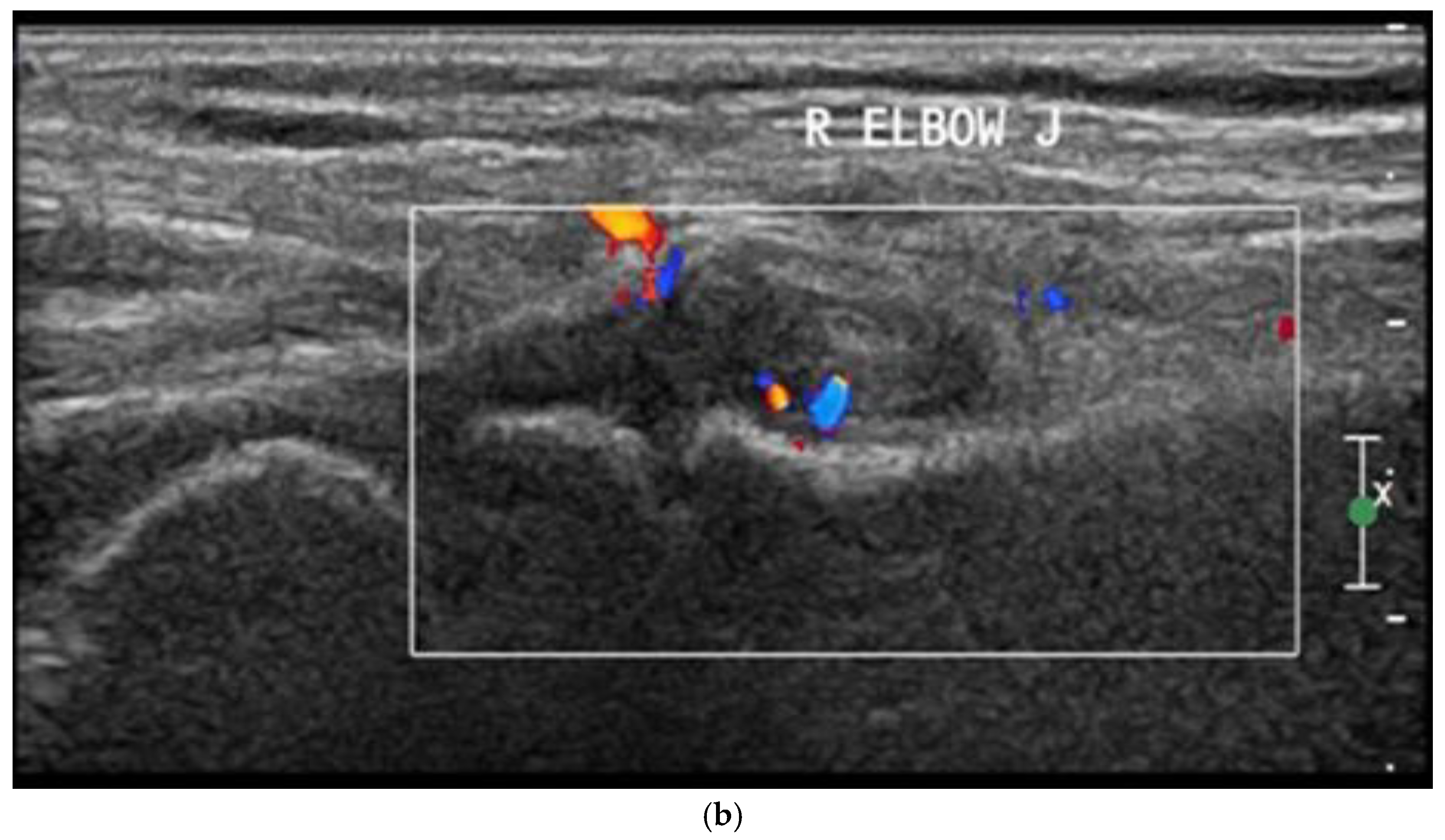 Ultrasound Features across Subtypes of Juvenile Idiopathic Arthritis