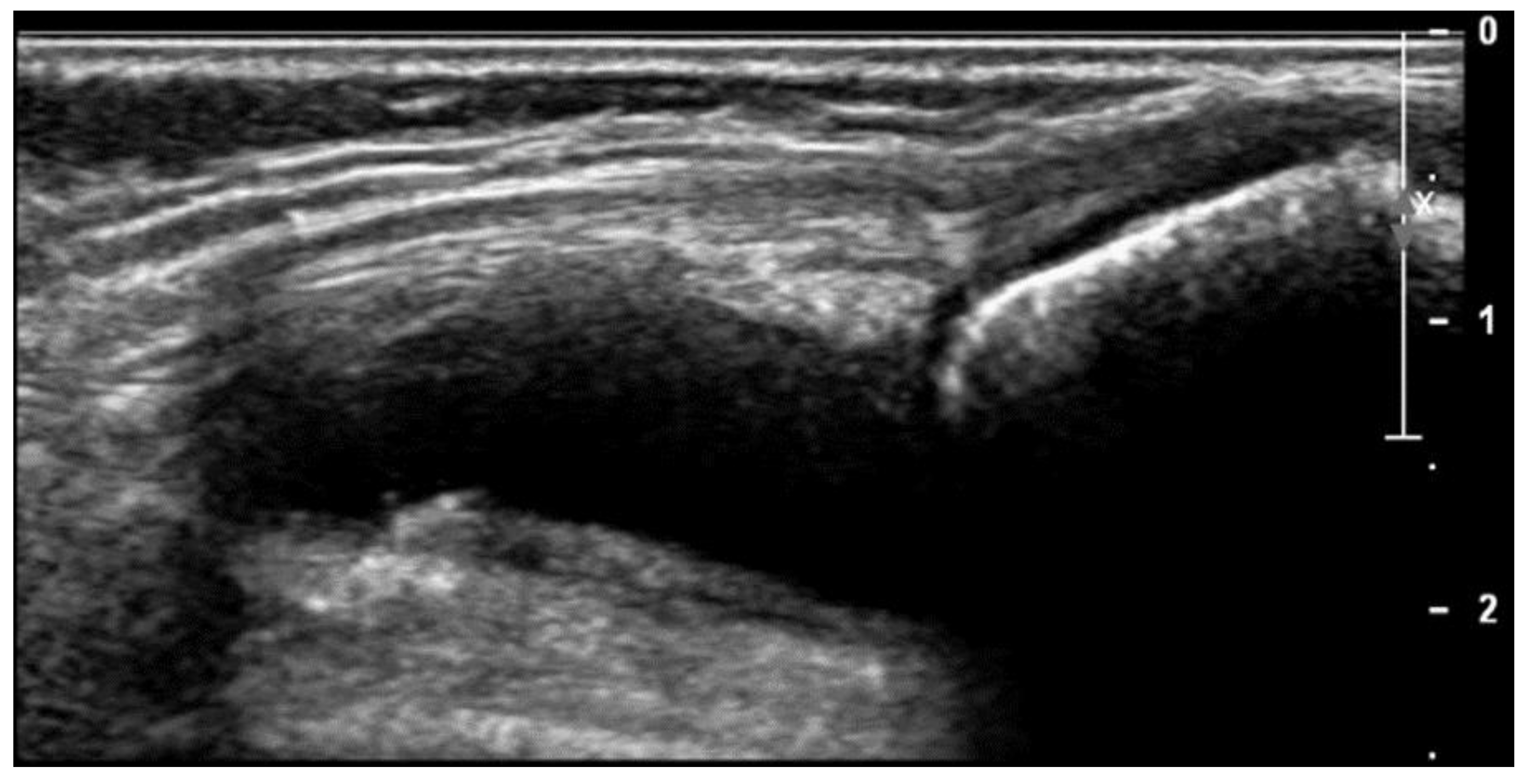 Ultrasound Features across Subtypes of Juvenile Idiopathic Arthritis
