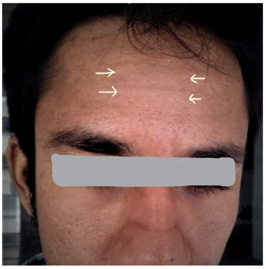 Pachydermoperiostosis Mimicking Inflammatory Arthritis: Case ...
