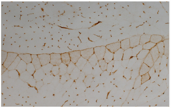 A Review of MDA-5 Dermatomyositis and Associated Interstitial Lung Disease
