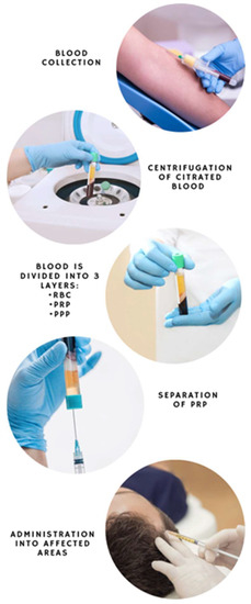 Effectiveness of Platelet-Rich Plasma in the Treatment of Androgenic ...