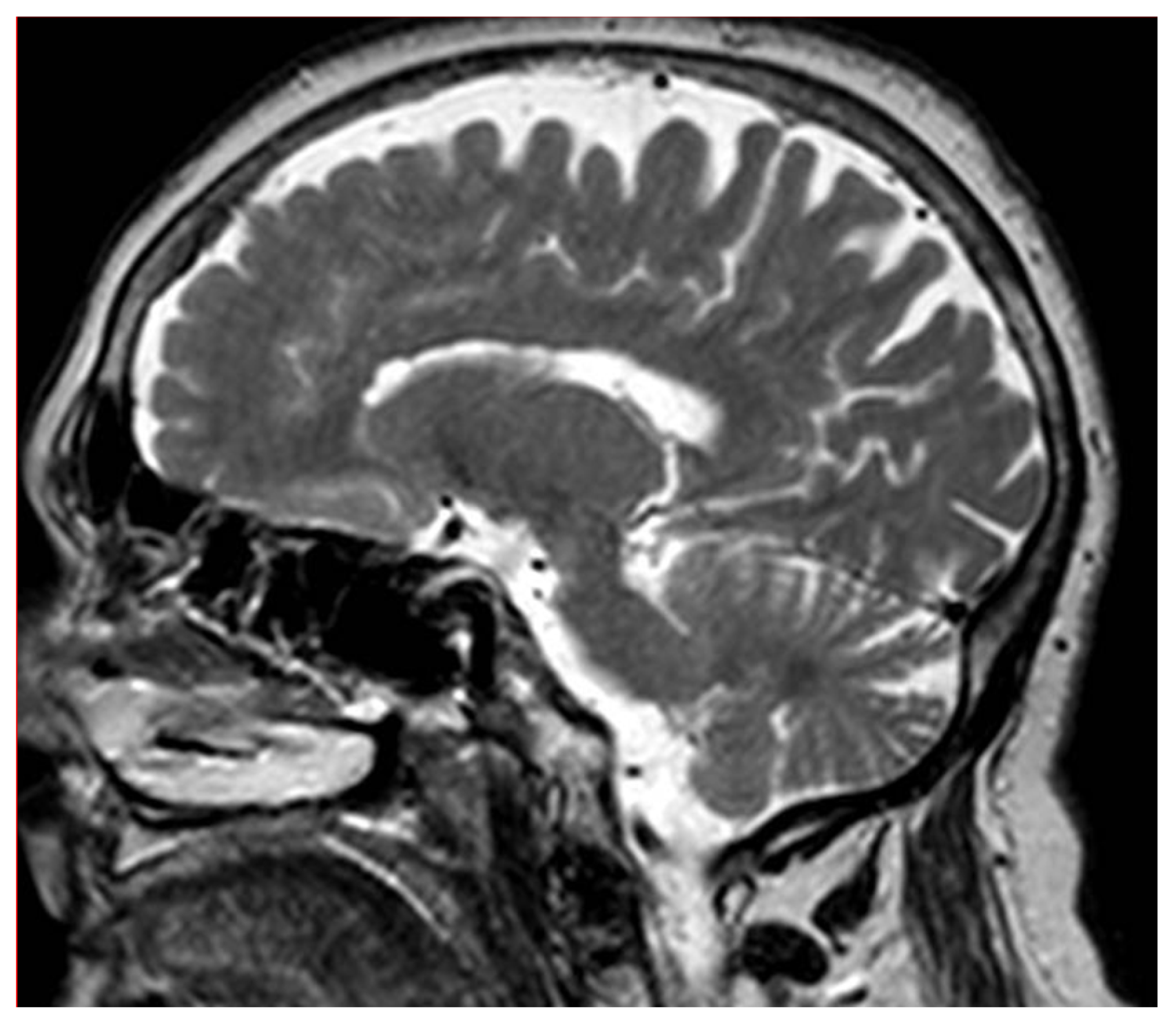 Anti-Yo Paraneoplastic Cerebellar Degeneration and Breast Cancer: A ...