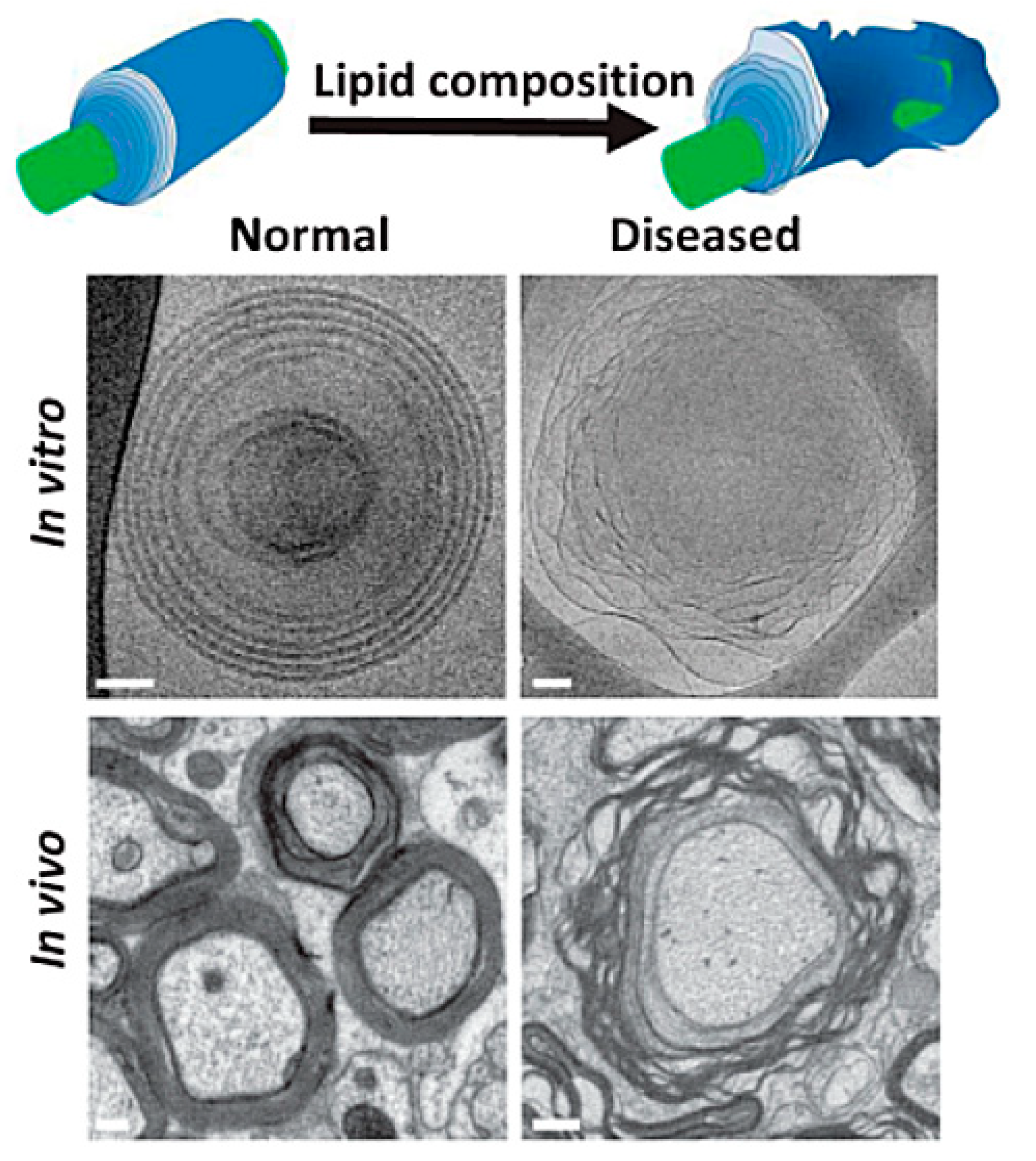 Multiple Sclerosis and Sodium Toxicity: Controversy and Future ...
