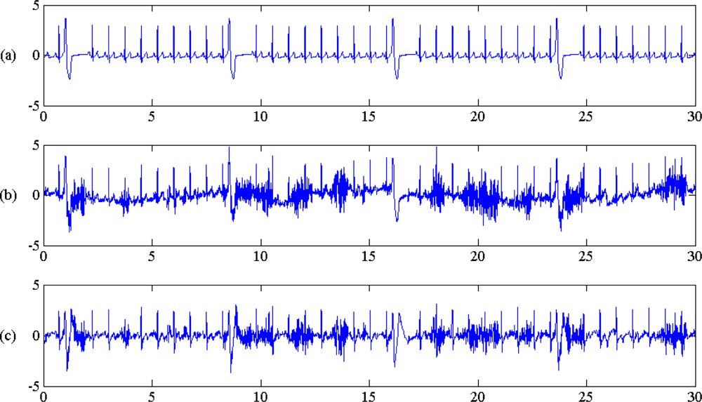 Arrhythmia ECG Noise Reduction by Ensemble Empirical Mode Decomposition