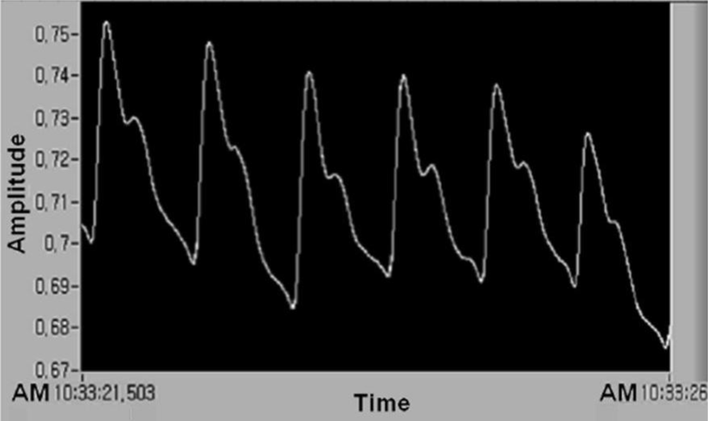 Measurement of Blood Pressure Using an Arterial Pulsimeter Equipped ...