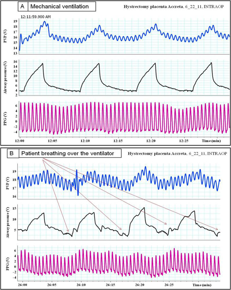 Respiratory Physiology and the Impact of Different Modes of Ventilation ...