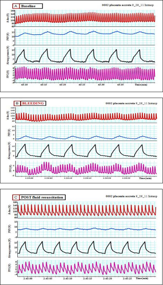 Respiratory Physiology and the Impact of Different Modes of Ventilation ...