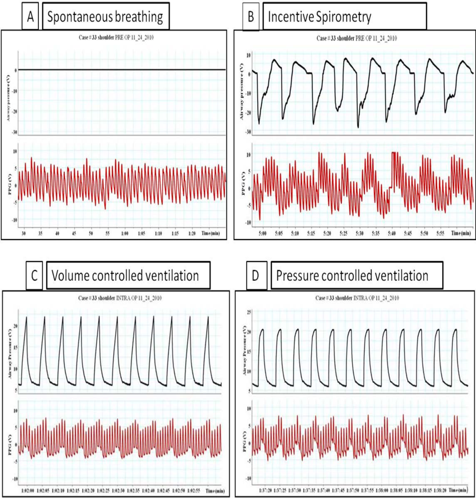 Respiratory Physiology and the Impact of Different Modes of Ventilation ...