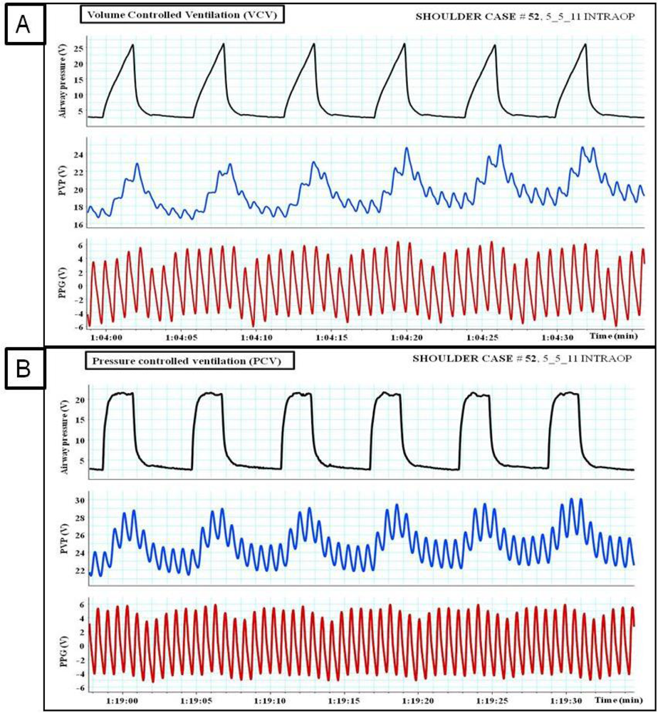 Respiratory Physiology and the Impact of Different Modes of Ventilation ...