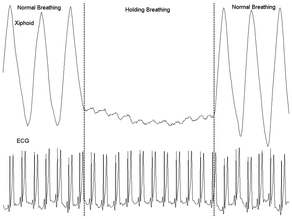 Development of a Respiratory Inductive Plethysmography Module ...