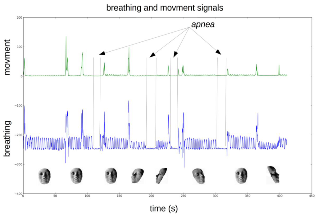 An Ultrasonic Contactless Sensor for Breathing Monitoring