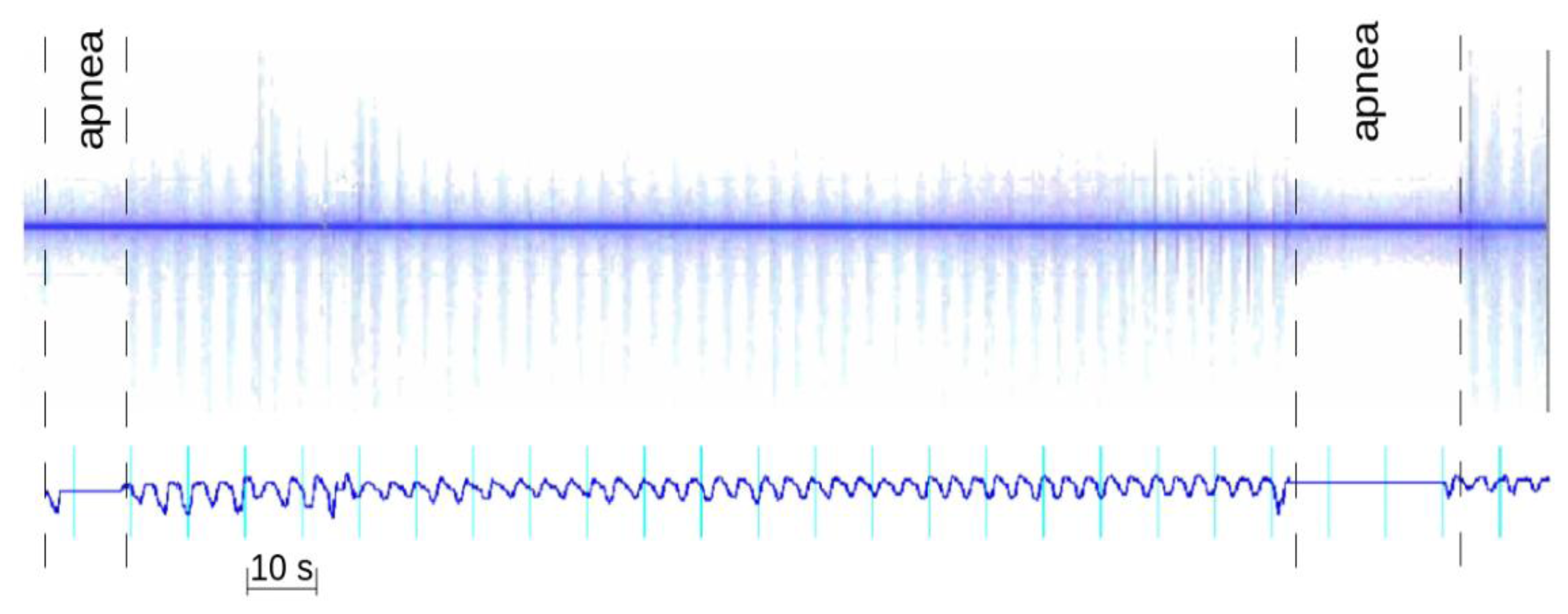 An Ultrasonic Contactless Sensor for Breathing Monitoring