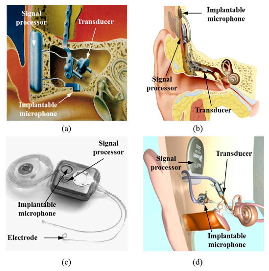 A New Trans-Tympanic Microphone Approach for Fully Implantable Hearing ...