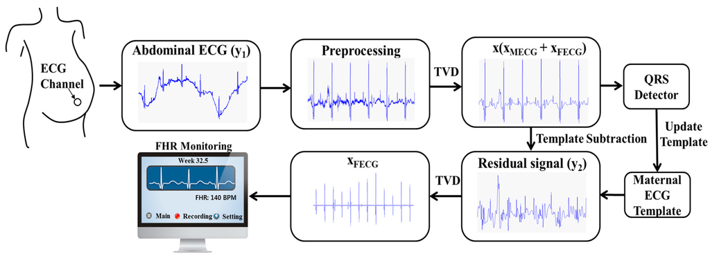 Sequential Total Variation Denoising for the Extraction of Fetal ECG ... Sequential Total Variation Denoising for the Extraction of Fetal ECG ...