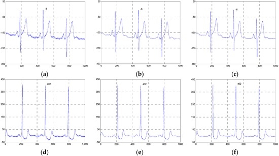 Sensors | Free Full-Text | Electrocardiogram Signal Denoising Using ...