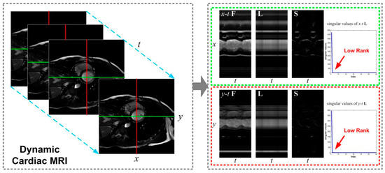 Reconstruction of Undersampled Big Dynamic MRI Data Using Non-Convex Low-Rank and Sparsity ...