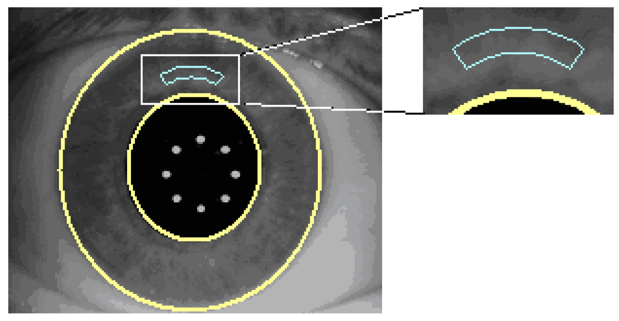 Excimer Laser Surgery: Biometrical Iris Eye Recognition with ...