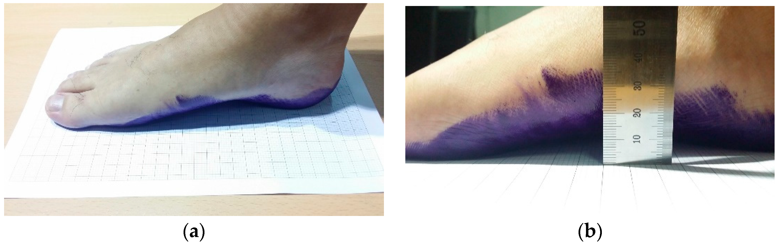 A Foot-Arch Parameter Measurement System Using a RGB-D Camera