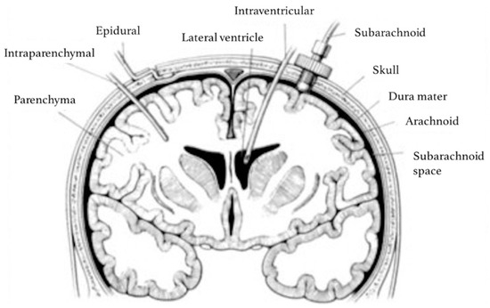 Intracranial Pressure KJNT :: Korean Journal Of Neurotrauma