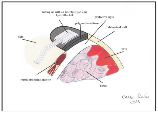 Pressure Distribution during Negative Pressure Wound Therapy of ...