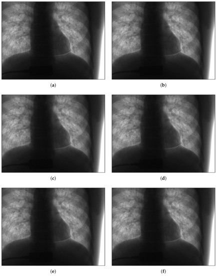 Poisson–Gaussian Noise Analysis and Estimation for Low-Dose X-ray ...
