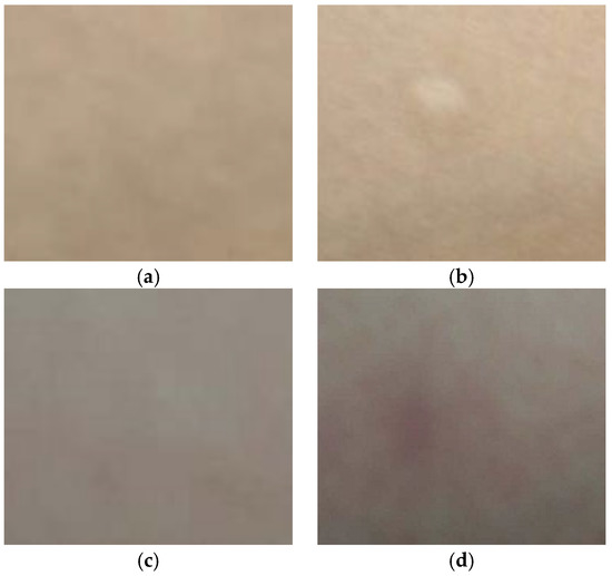 A Flexible Interdigital Electrode Used in Skin Penetration Promotion ...